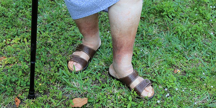 Trombose tem cura? Entenda o que é, sintomas e como tratar